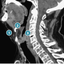 Head and Neck Cancer Lymphedema